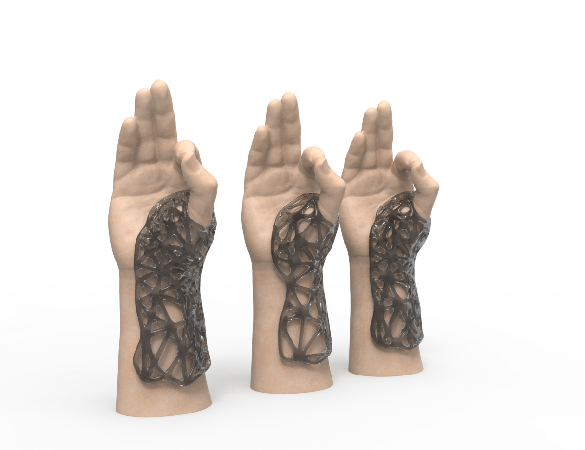 Parametric models for 3D printing of orthosis for hand injuries